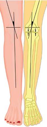 Genu Valgum - Penatalaksanaan Fisioterapi - HaloFisioterapi