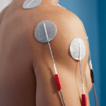 Transcutaneous Electrical Nerve Stimulation (TENS) - HaloFisioterapi