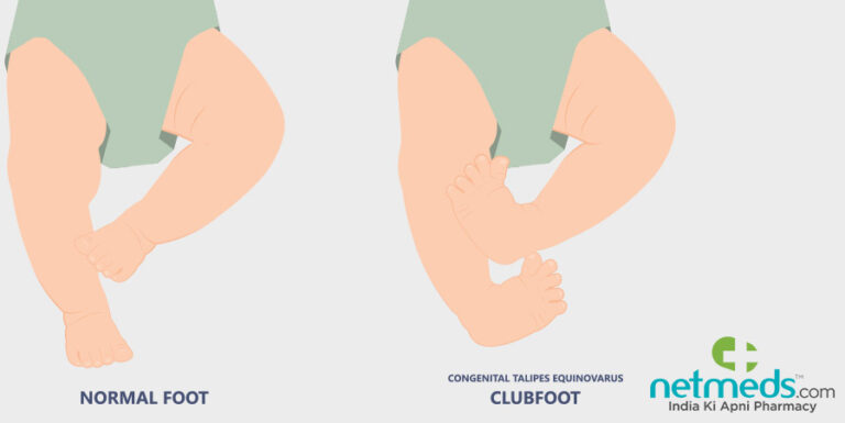 CTEV : Kenali Deformitas Pada Kaki Bayi - HaloFisioterapi